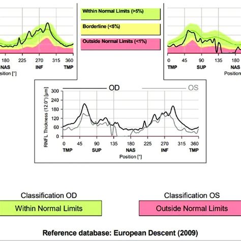 Oct Rnfl Showing Normal Appearance In Od Nasal And Temporal Thinning