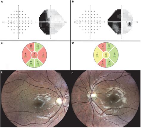 Which Is And Nasal Visual Field Interpretation