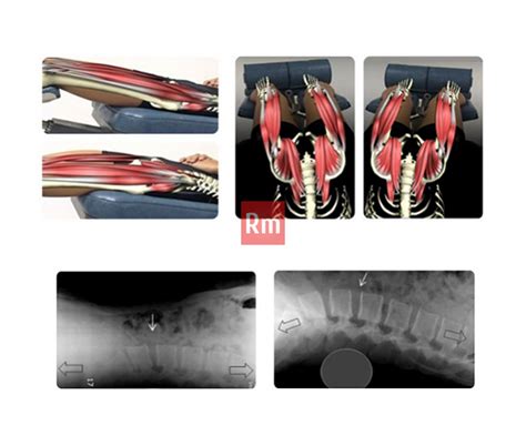 Тракционный стол для вытяжения позвоночника Kinetrac Knx7000 Reamed