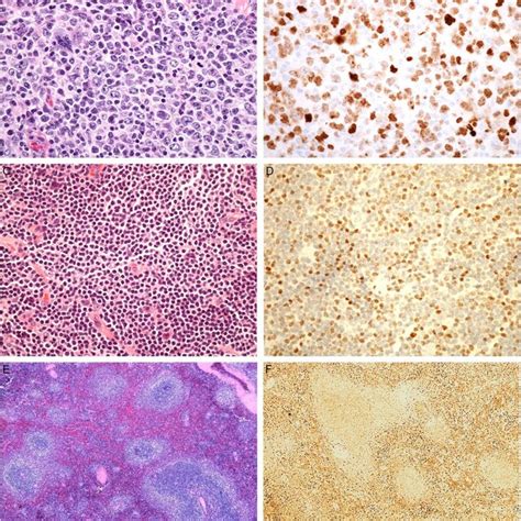 Expression Of Myeloid Nuclear Differentiation Antigen And P53 A ×10