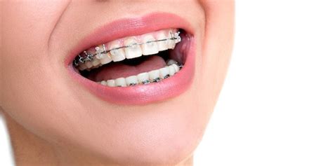 Ortodoncistas En Metepec City Dental Especialistas