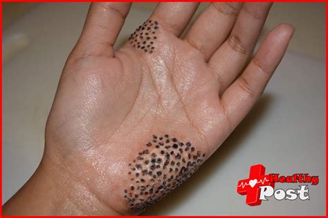 Trypophobia Symptoms Cause And Treatment