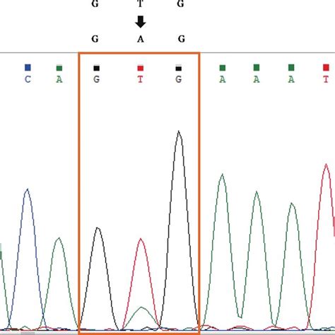 Braf V600e Mutation Analysis Direct Dna Sequencing Data From The Bone
