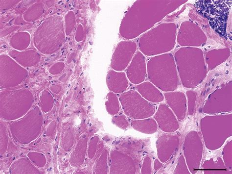 Muscle Biopsy What And Why And When Practical Neurology