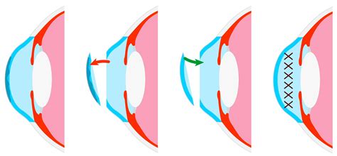 Corneal Transplant Surgery And Keratoplasty In Kansas City Mo Discover