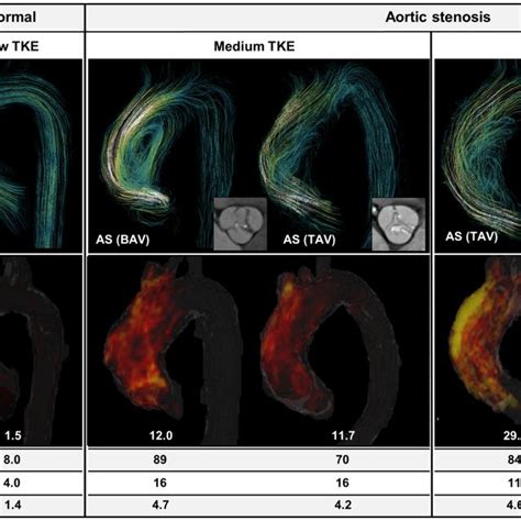 4d Pc Mri And Echocardiographic Findings In Four Patients With Aortic Download Scientific