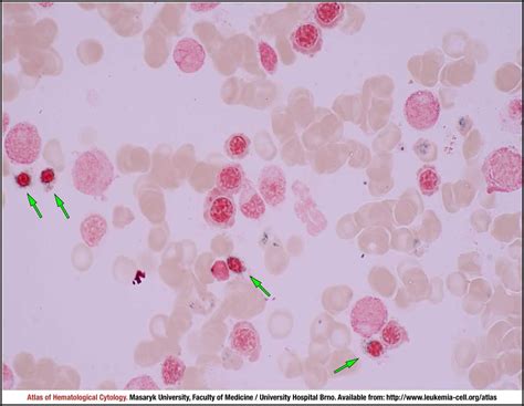 Myelodysplastic Syndrome With Excess Blasts Mds Eb 1 Cell Atlas