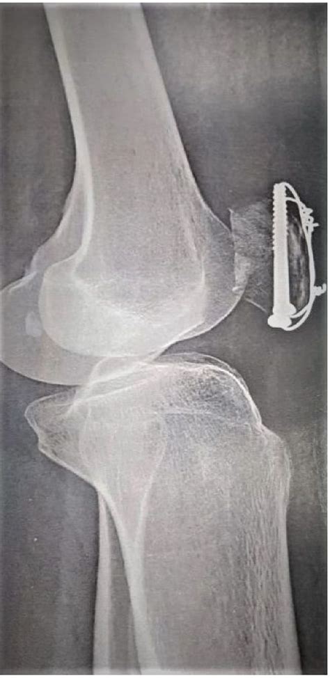 Pdf Outcome Of Transverse Patella Fractures Fixed With Cannulated
