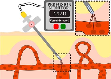 Figure 1 From Potential Of Laser Doppler Flowmetry In The Medical