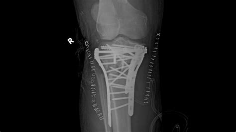 Three Column Classification Of Proximal Tibiatibial Plateau Fractures