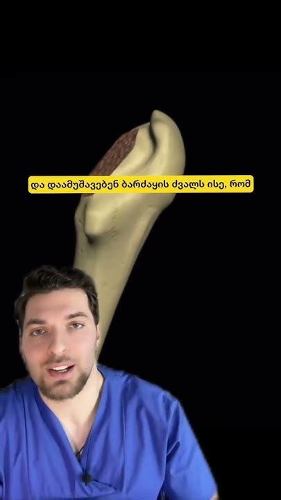 როგორ კეთდება მენჯ ბარძაყის პროთეზირება მედიცინის სამედიცინო ექიმი Youtube