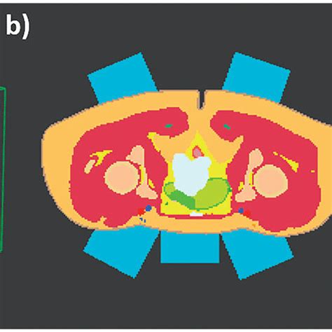 modular applicator module placement for the bladder tumor setup a