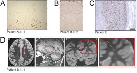 Neuropathological Findings A In Individual A Iii 1 Neun Staining