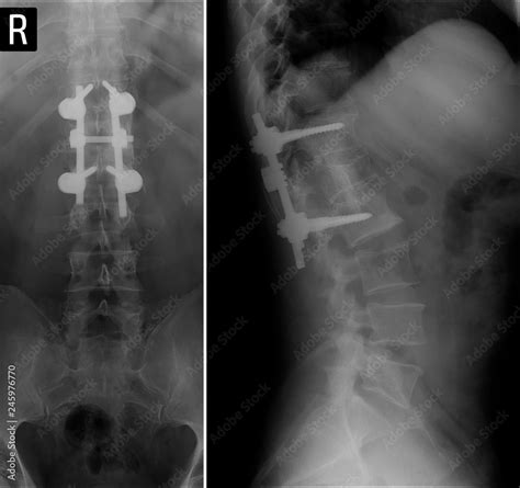 X Ray Of The Lumbar Spine Compression Fracture Of The Vertebral Body L1 Spinal Fusion Stock