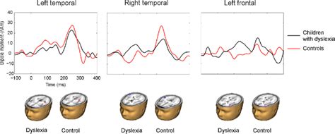 Top Source Waveforms Obtained From Ecd Analysis For Left Temporal