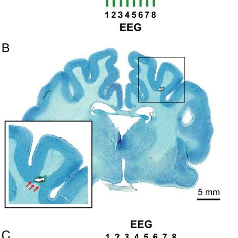 Patterns Of Eeg Activity Under Ketamine Xylazine Anesthesia A Eeg