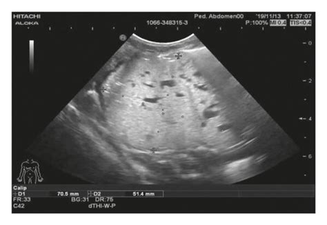 An Irregular Mixed Echo Mass Can Be Seen In The Right Lung Field