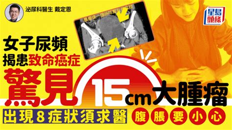卵巢癌女子尿頻揭腫瘤15cm大 確診癌症致命率高 出現腹脹8症狀須求醫 星島日報