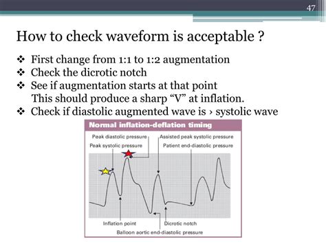 Ppt Iabp Instrumentation Indications And Complications Powerpoint
