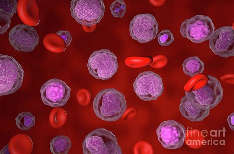 Non Hodgkins Lymphoma Cells By Nemes Laszloscience Photo Library