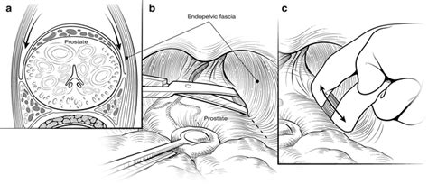 Retropubic Prostatectomy Incision