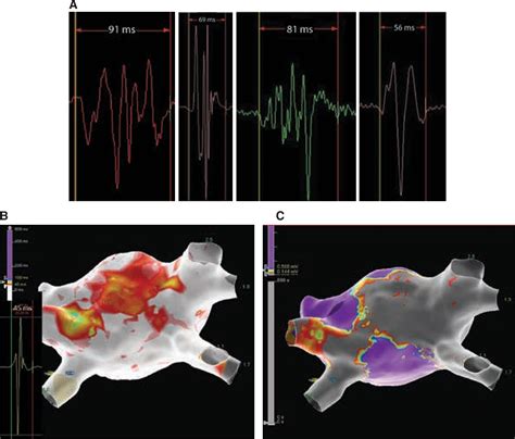 Figure 1 From Map Of Prolonged Electrogram Duration To Guide Atrial
