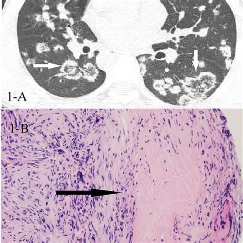 Pdf Reversed Halo Sign Presents In Different Pulmonary Diseases
