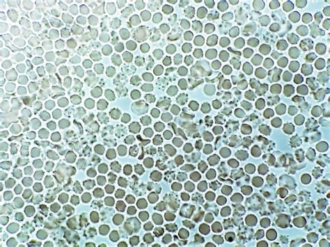 Premium Photo Photomicrograph Of Sickle Cell Anemia Sickling Test