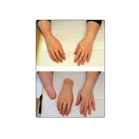 Silicone Partial Hand Prosthesis At Best Price In Bengaluru Kare Prosthetics And Orthotics