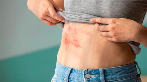 HERPES ZÓSTER Causas sintomas e tratamento