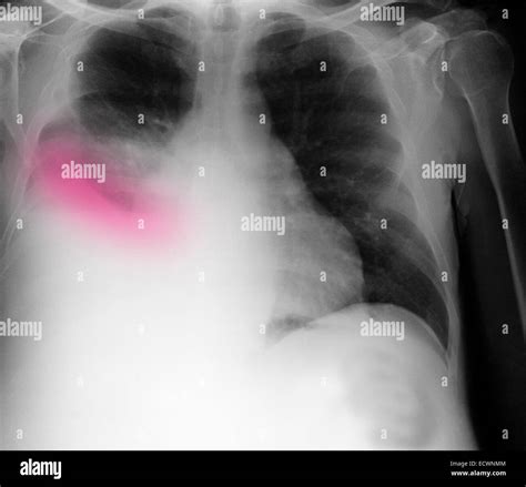 Pleural Effusion X Ray