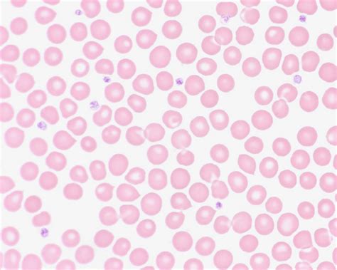 血小板细胞学形态评估：正常形态、巨血小板、活化血小板、少颗粒血小板、空泡血小板物镜肿瘤细胞质