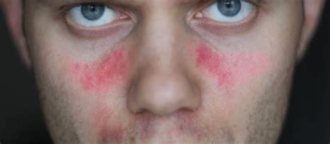 Sex Based Clinical Variations In Systemic Lupus Erythematosus