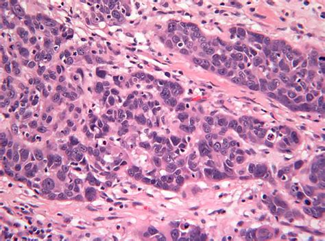 Laryngeal Cancer Staging