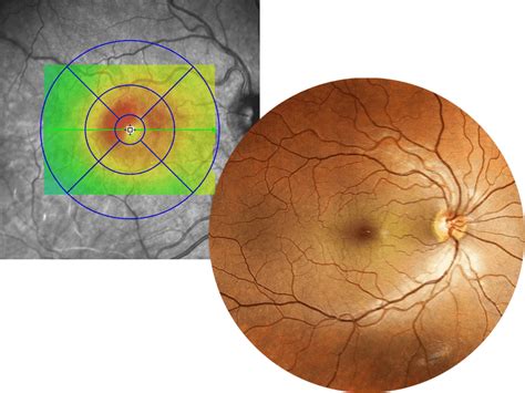 About Tyson Eye Ophthalmologist Naples Eye Doctor Fort Myers