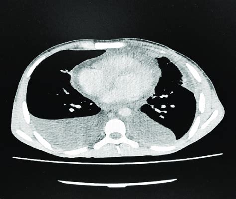 Computed Tomography Scan Showing Bilateral Pleural Effusion And Download Scientific Diagram