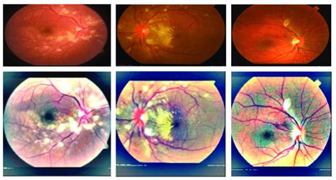 A Visual Example Of The Preprocessing Step To Enhance Retinograph
