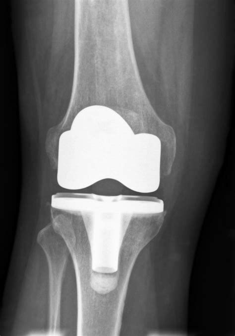 Knee Replacement Surgery Northeast Georgia Medical Center