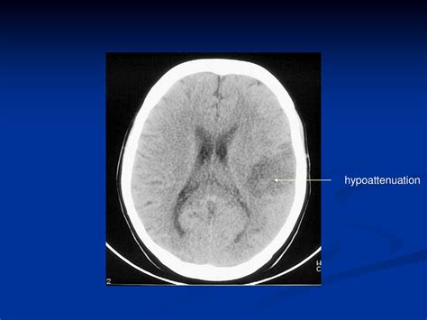 Stroke Cases And Evidence Based Treatment Ppt Download