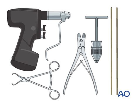 Closed Reduction K Wire Fixation For Epiphysiolysis Salter Harris I