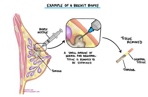 Your Pathology Report For Malignant Phyllodes Tumour Of The Breast Mypathologyreport