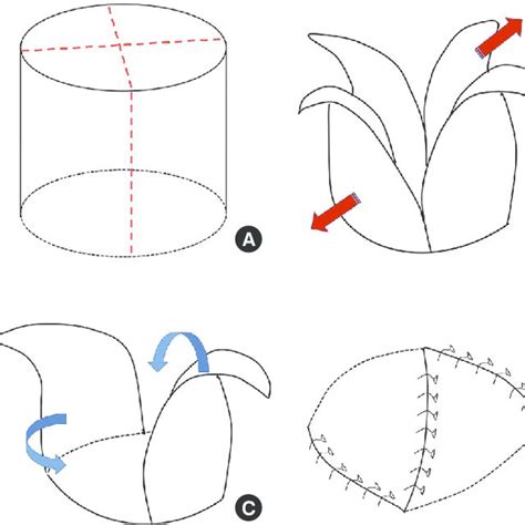 A 53 Year Old Female Patient After The Operation The Triangular Flap