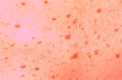 Papular Eruption Pictures Photos