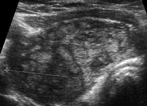 thyroid nodule ultrasound