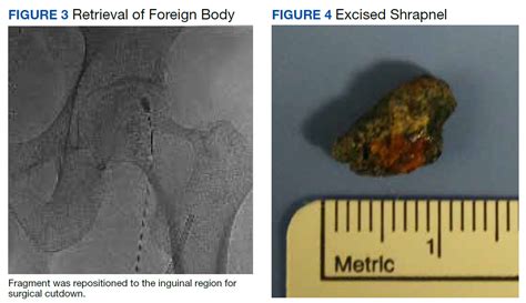 Catheter Directed Retrieval Of An Infected Fragment In A Vietnam War