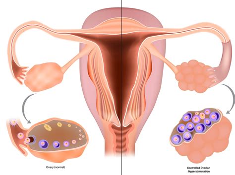 Unraveling Unexplained Infertility In Embryogenesis
