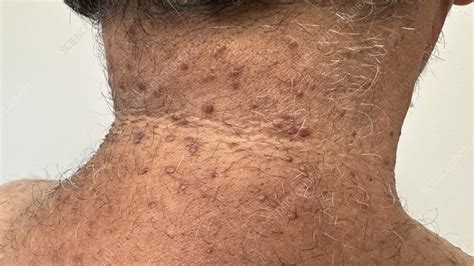 Generalised Eruptive Histiocytoma Stock Image C0599204 Science