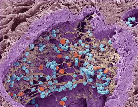 Appendicitis Sem Stock Image C0572522 Science Photo Library