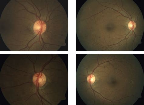 Treating Proliferative Diabetic Retinopathy