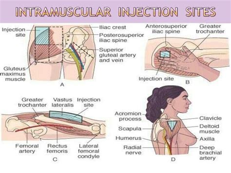 Intramuscular Injection